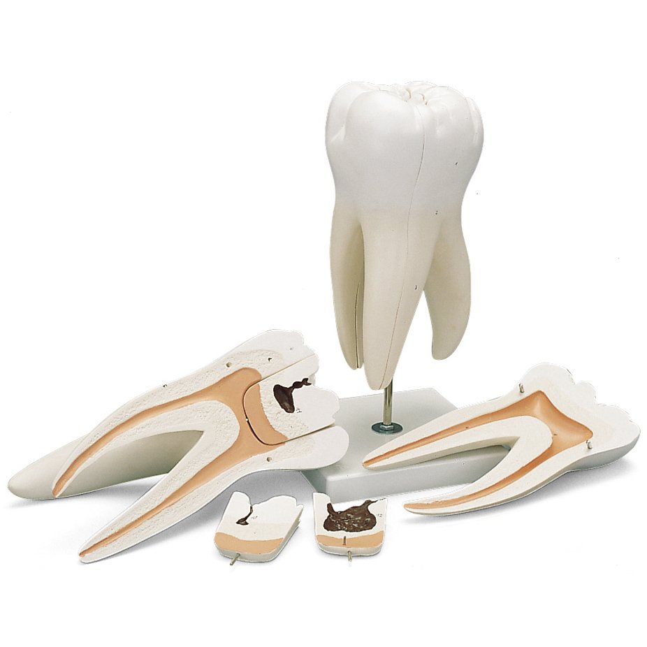 3B Scientific D15 Giant Molar with Dental Cavities 5-Part