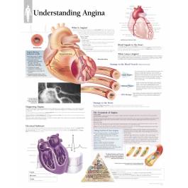 Scientific Publishing Understanding Angina Poster Angina Education Chart