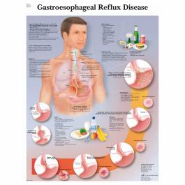 3B Scientific Gastroesophageal Reflux Disease Chart (GERD)