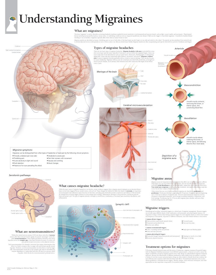 Migraine Brain Diagram