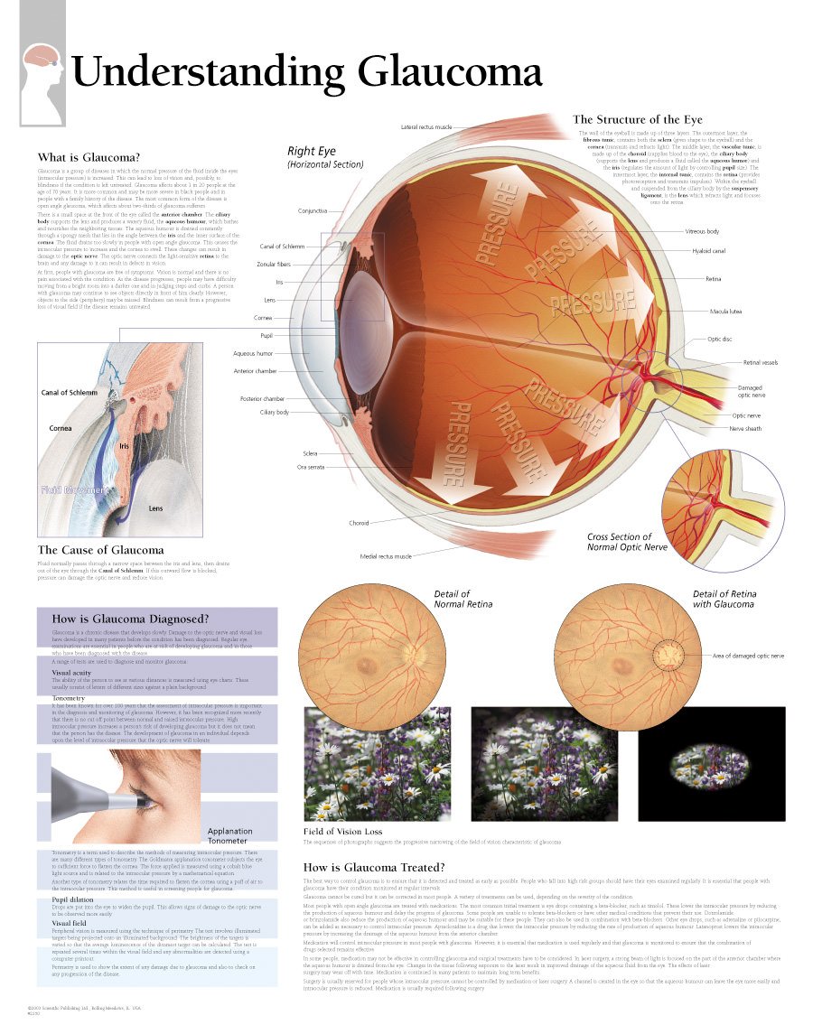glaucoma nos