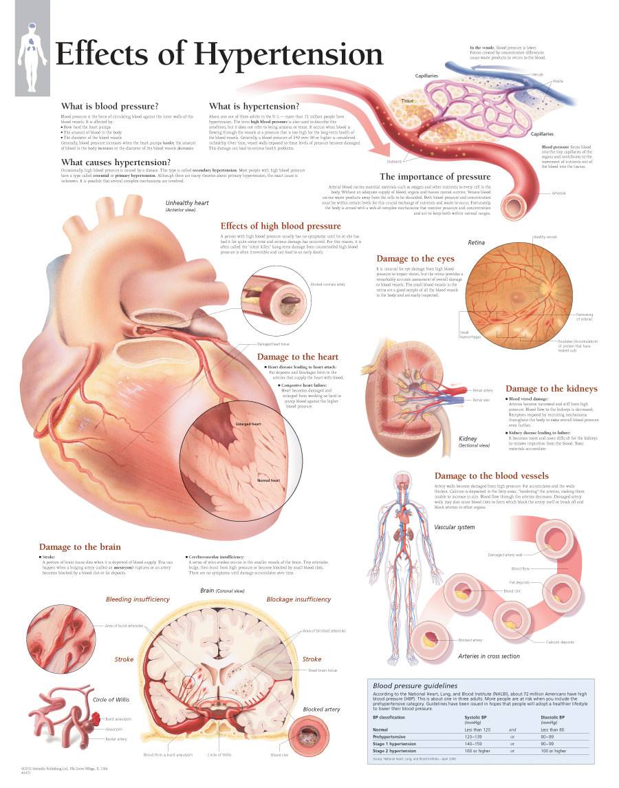 Scientific Publishing Effects Of Hypertension Chart Scientific Publishing Effects Of Hypertension Chart