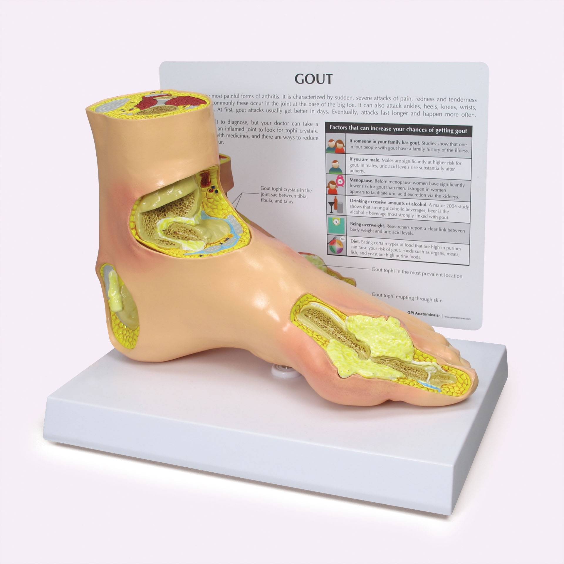 Gpi Anatomicals 1985 Foot Gout Model