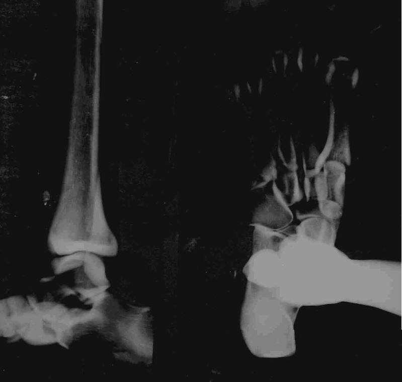 RSD Anthropomorphic Foot Ankle Phantom