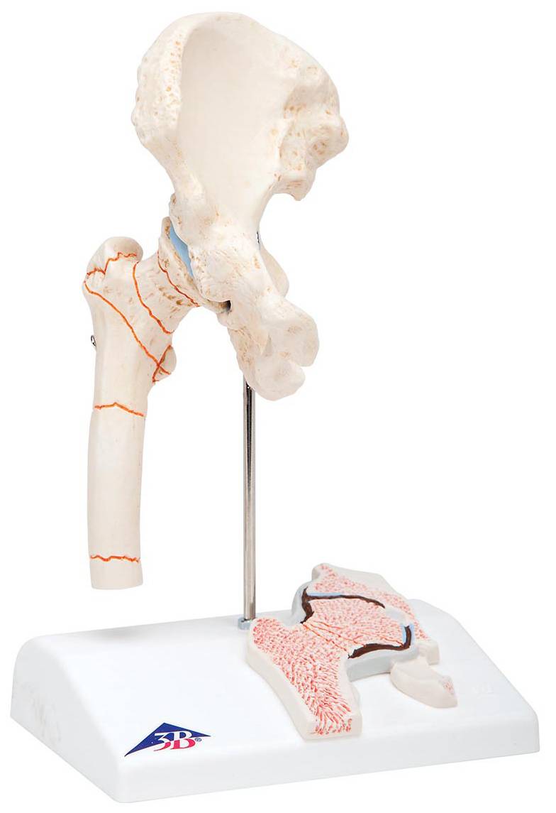 3B Scientific A88 Femoral Fracture and Hip Osteoarthritis Model