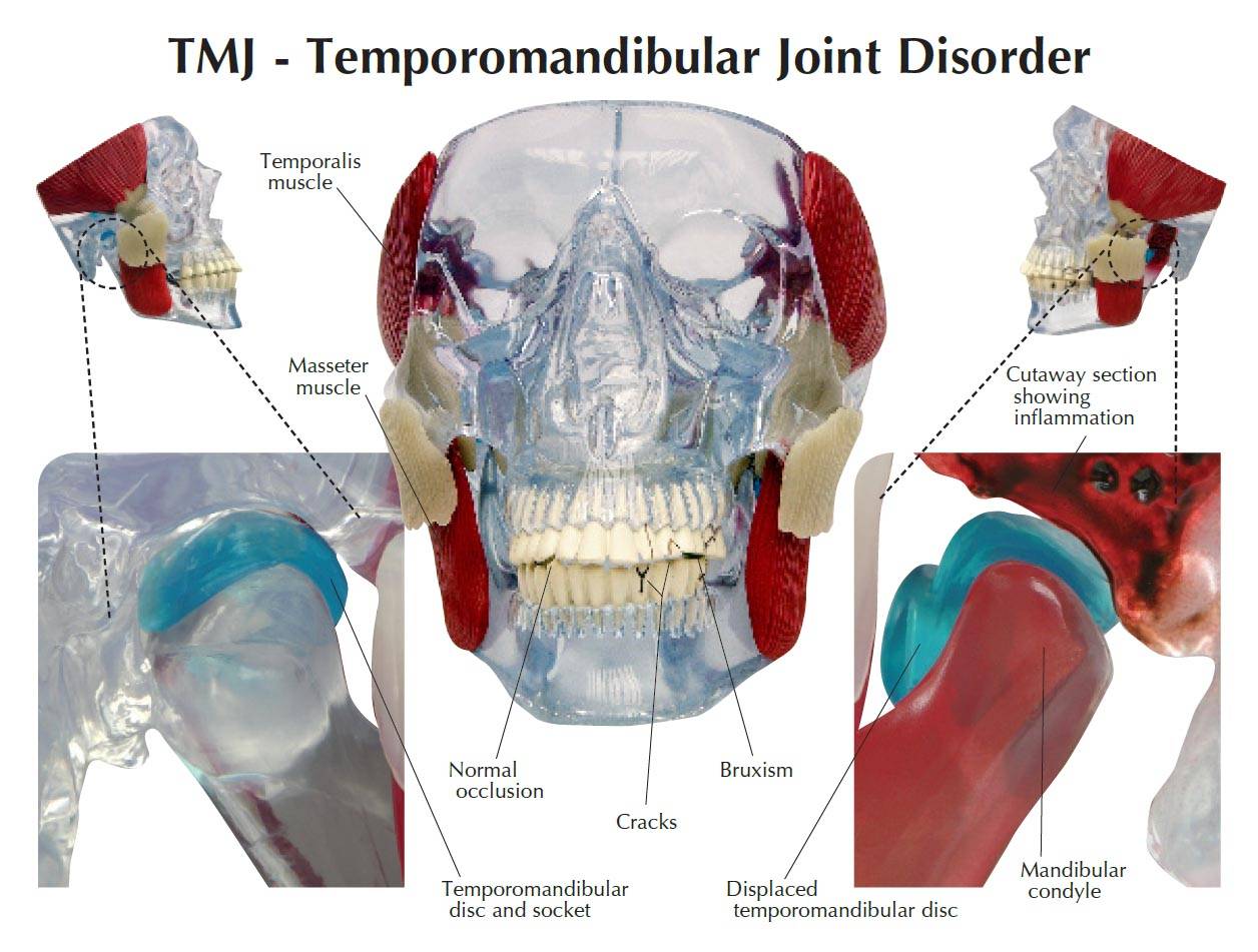 GPI 2880 TMJ Clear Skull with Muscles Model