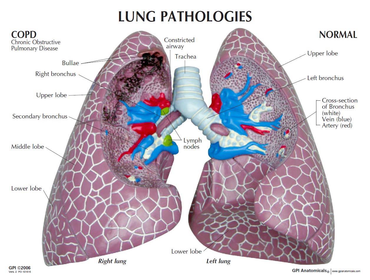 Diseased Lung