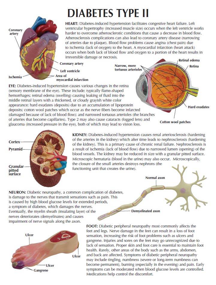 GPI 4010 Type II Diabetes Set Model