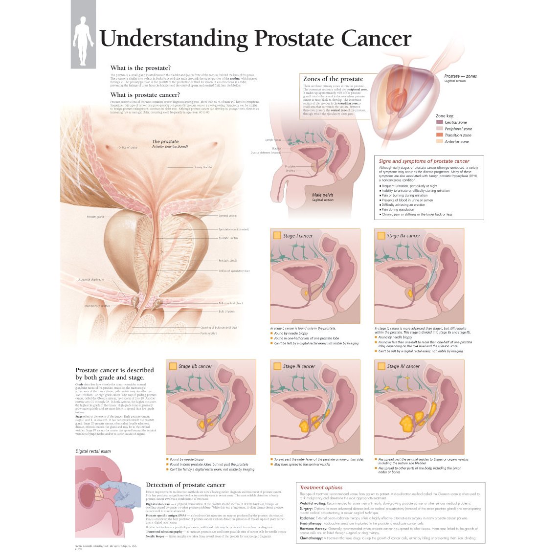 Understanding Prostate Cancer Chart from Scientific Publishing Understanding Prostate Cancer Chart from Scientific Publishing