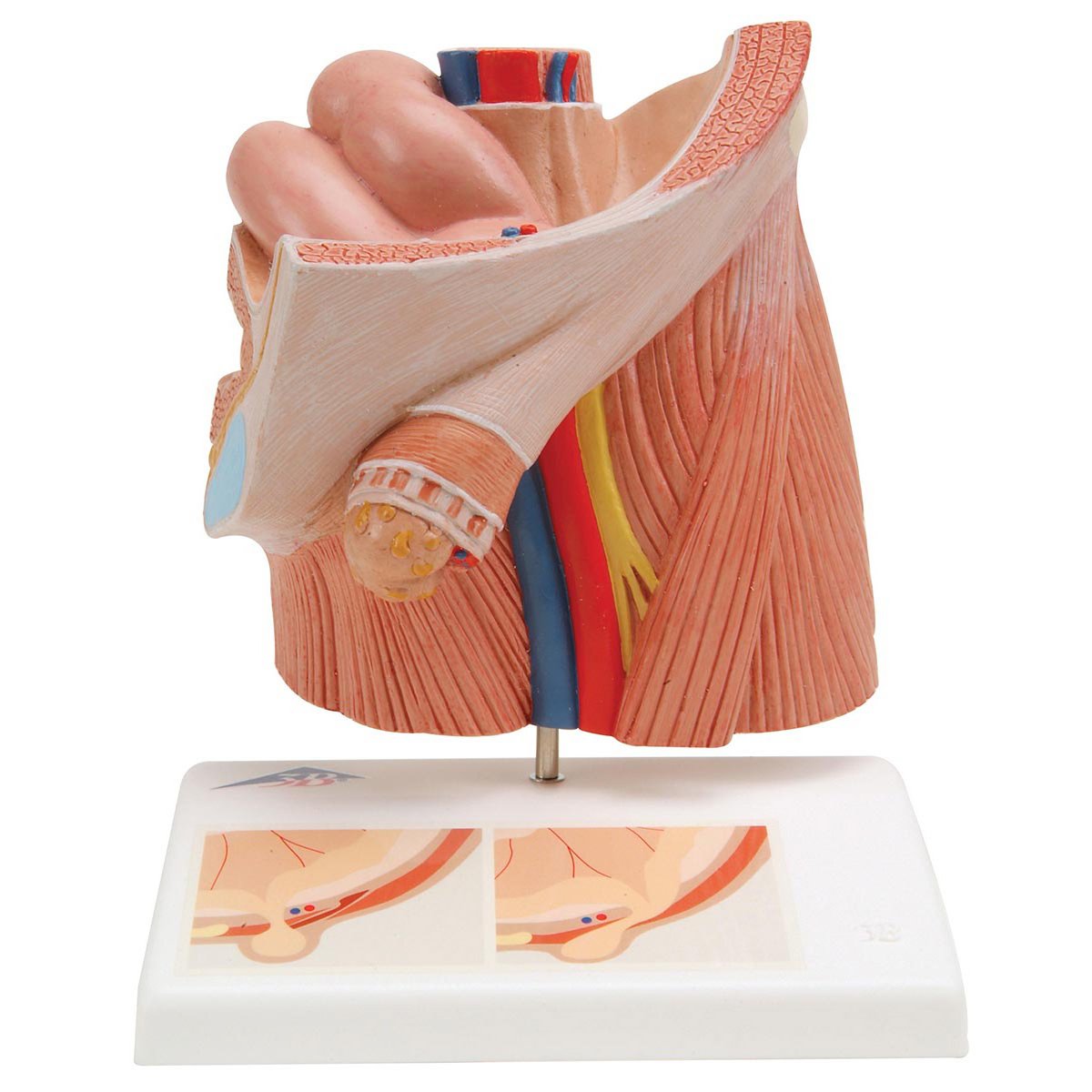 3B Scientific H13 Inguinal Hernia Model