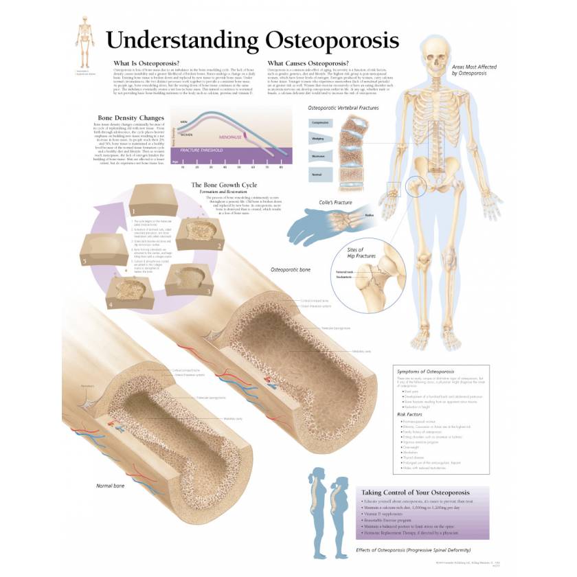 Scientific Publishing Understanding Osteoporosis Chart