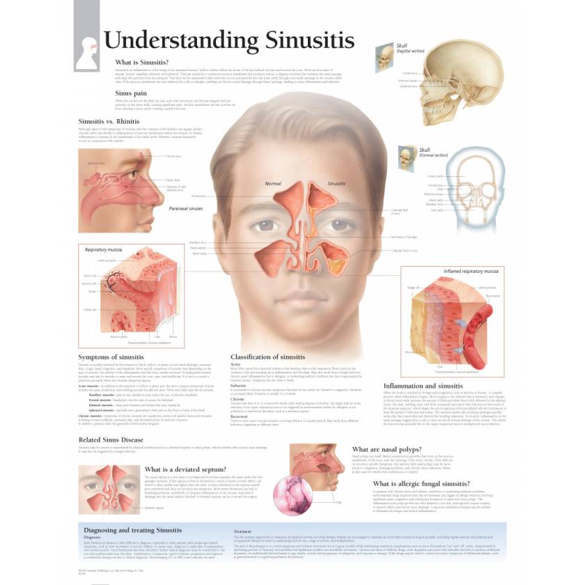 Scientific Publishing Understanding Sinusitis Chart