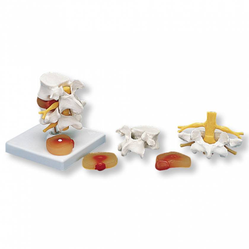 3B Scientific A76 Lumbar Vertebrae Teaching Model