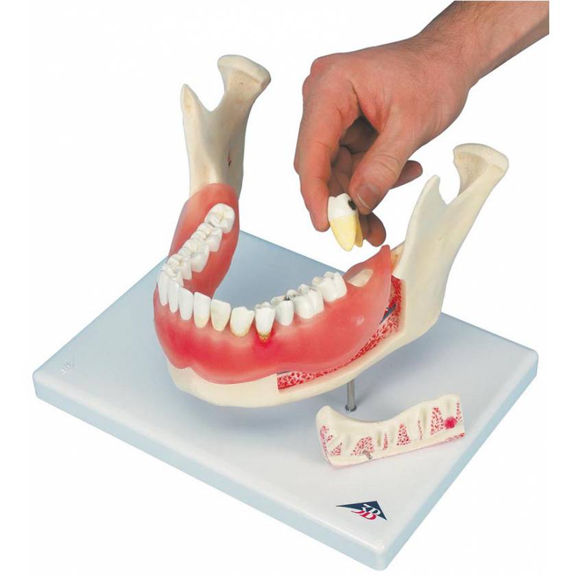 3B Scientific D26 Diseases of the Teeth Jaw Model 21-Part