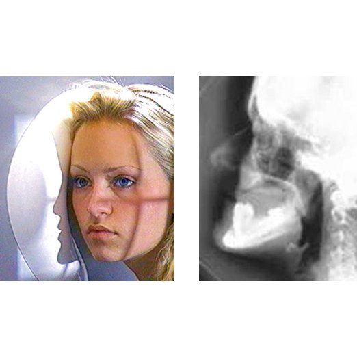 Boomerang X-Ray Filters by Octostop