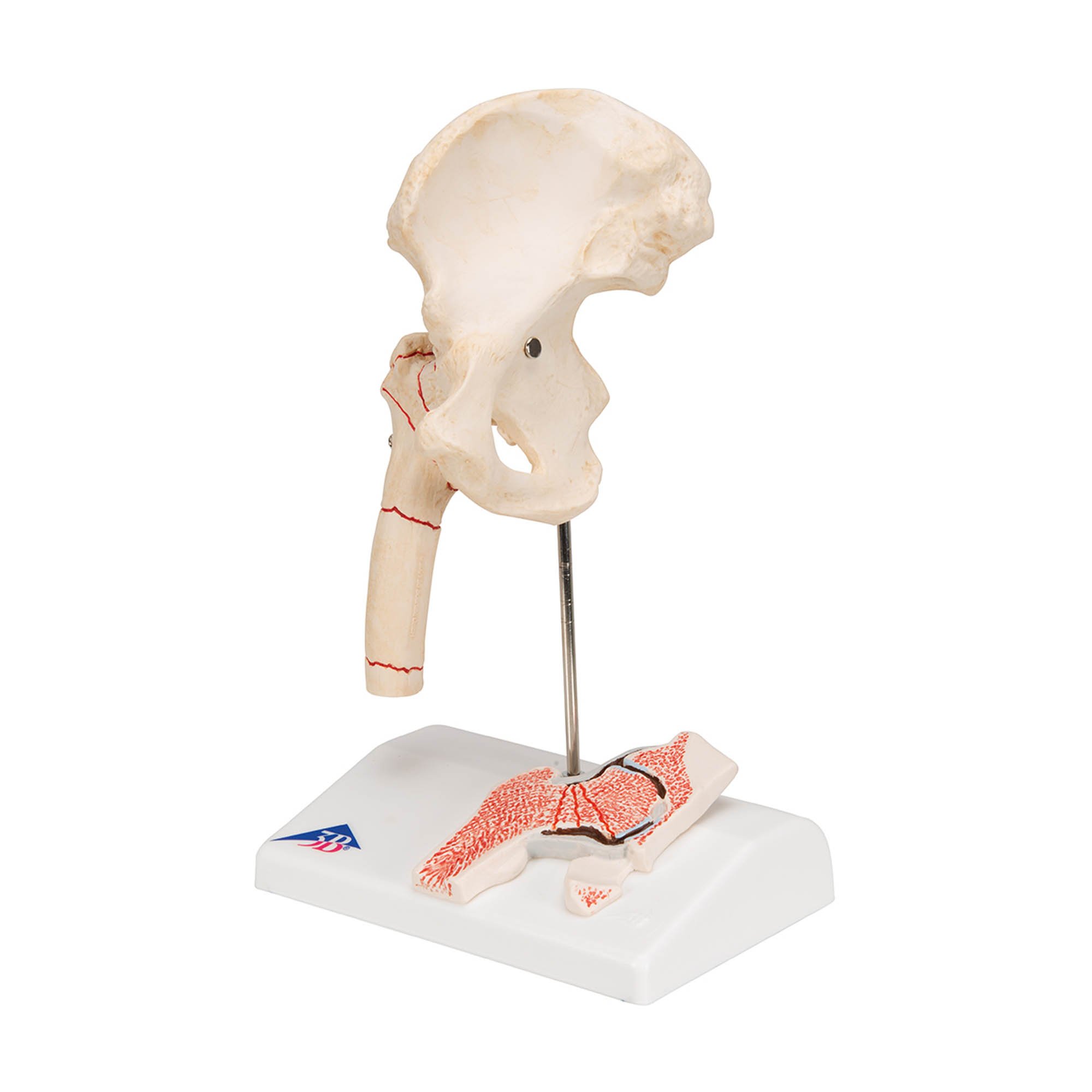 3B Scientific A88 Femoral Fracture and Hip Osteoarthritis Model