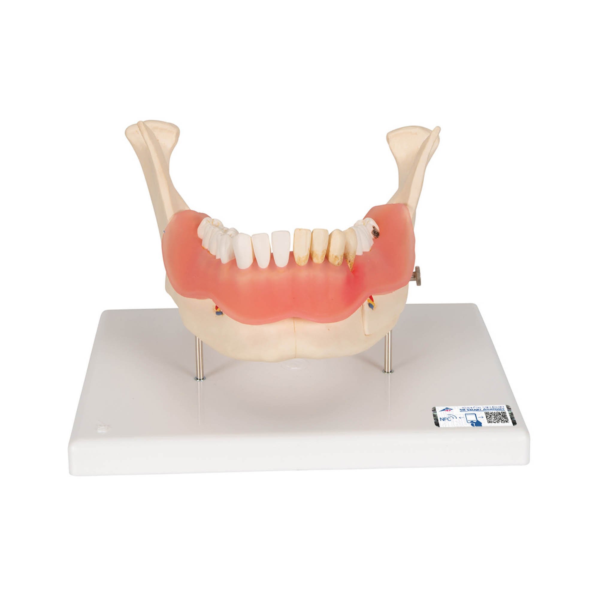 3B Scientific D26 Diseases of the Teeth Jaw Model 21-Part