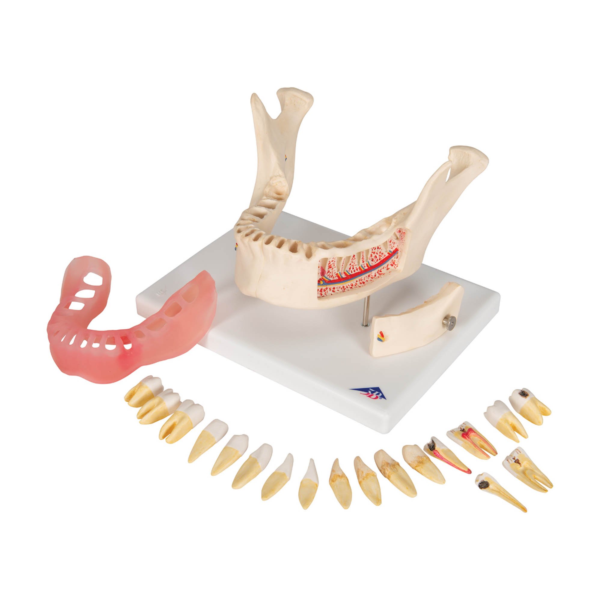 3B Scientific D26 Diseases of the Teeth Jaw Model 21-Part