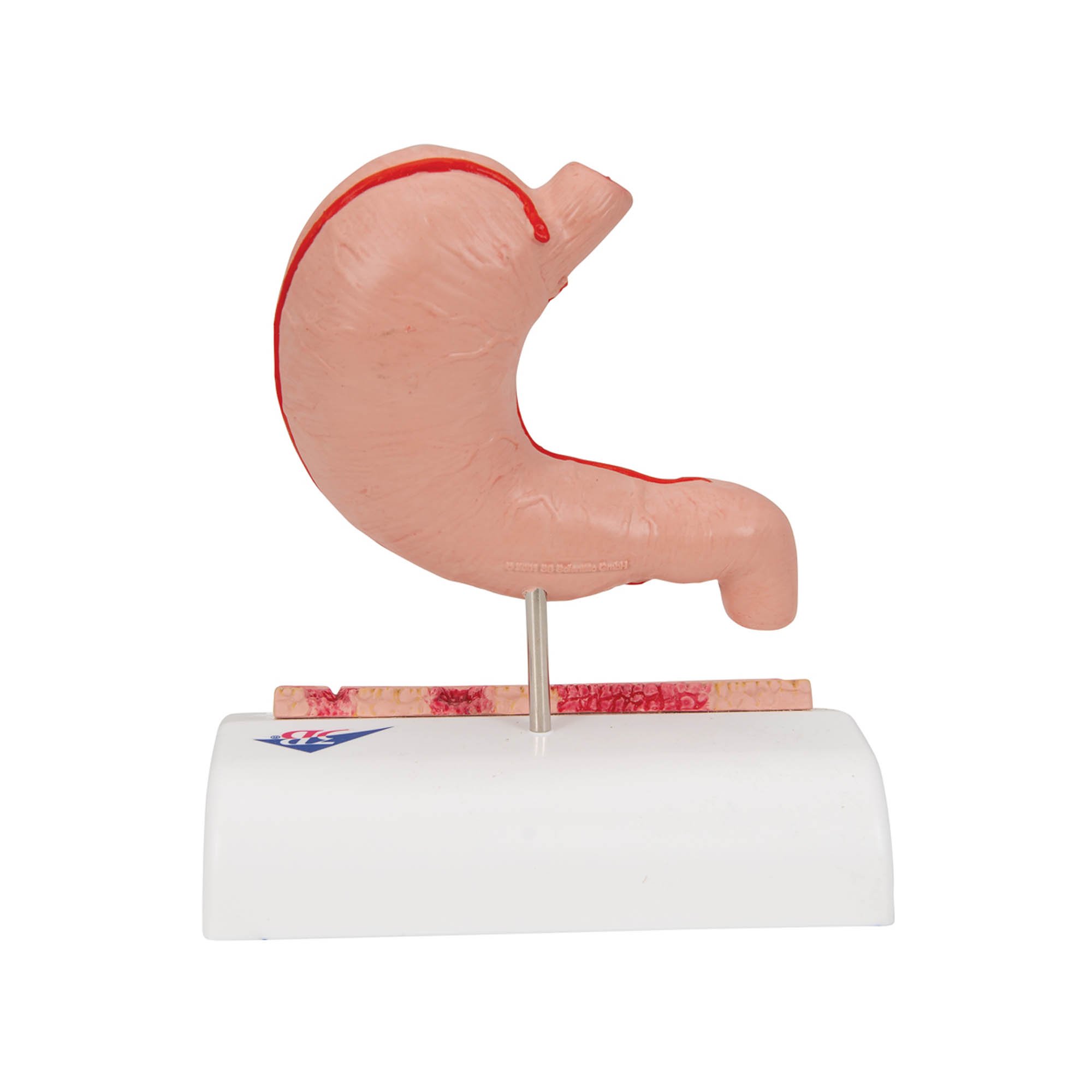 3B Scientific K17 Stomach with Ulcers Model
