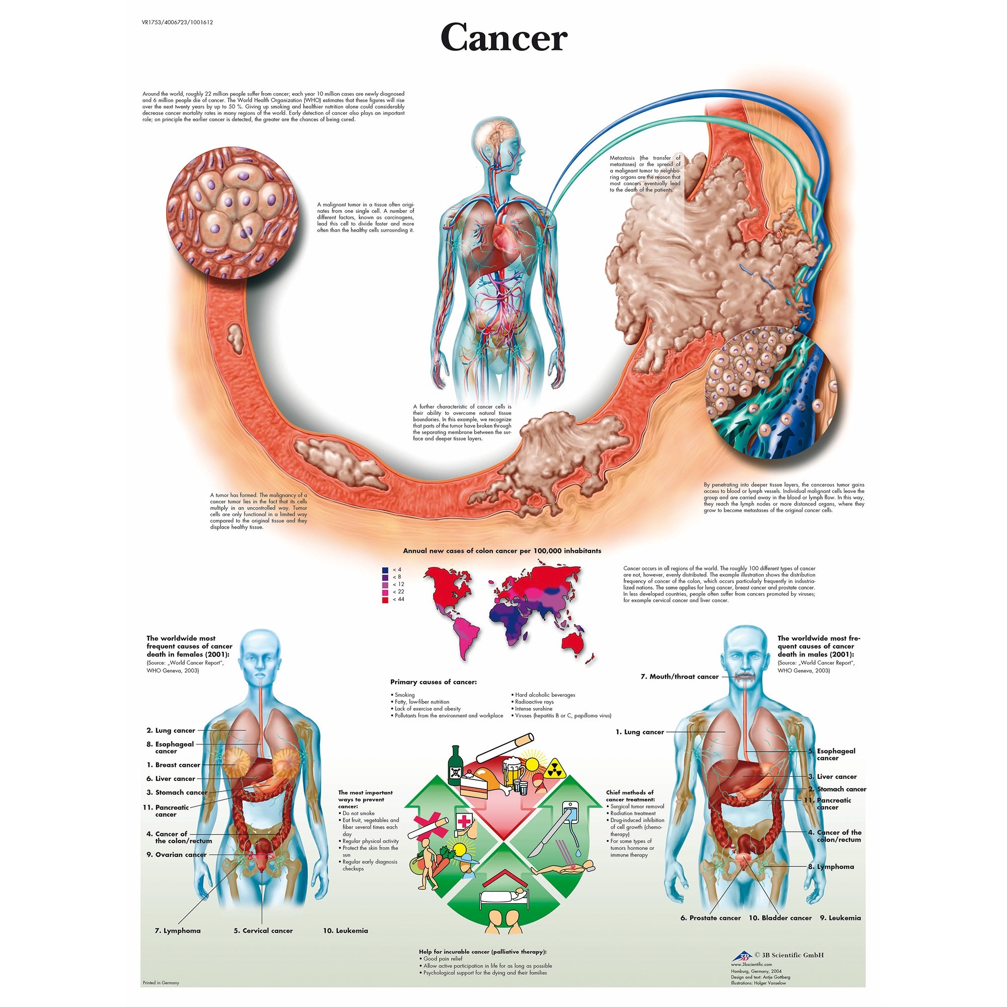 3B Scientific Cancer Chart 3B Scientific Cancer Chart